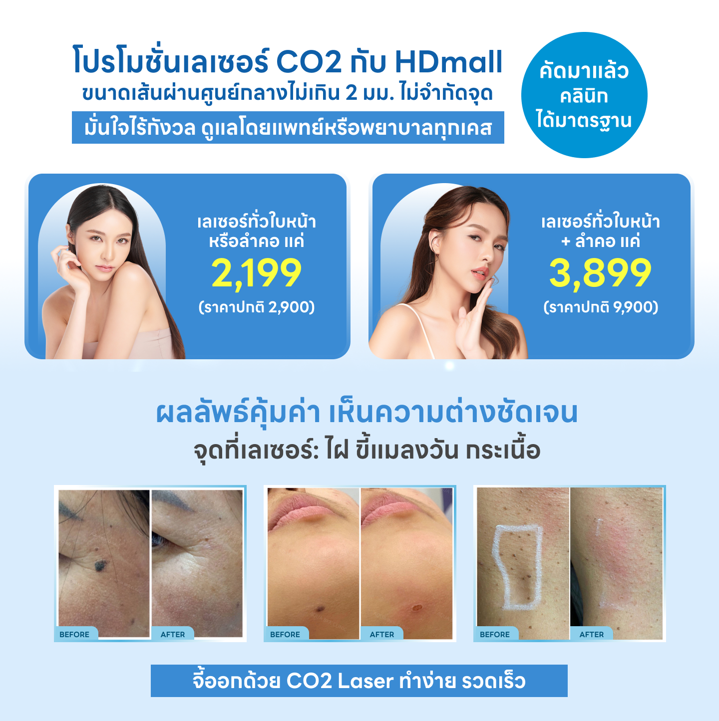 จี้ไฝ ขี้แมลงวัน ติ่งเนื้อ ด้วย CO2 Laser ราคาพิเศษ เฉพาะที่ HDmall - ราคา 2568
